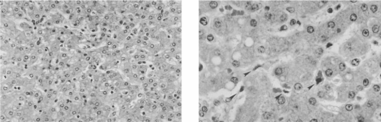 Machupo Virus: Bolivian Hemorrhagic Fever