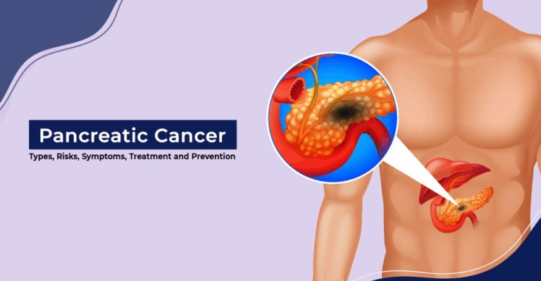 Pancreatic Cancer: A Comprehensive Guide