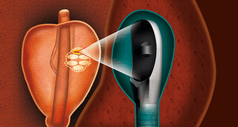 TULSA-PRO: The Latest Procedure for Prostate Cancer Treatment