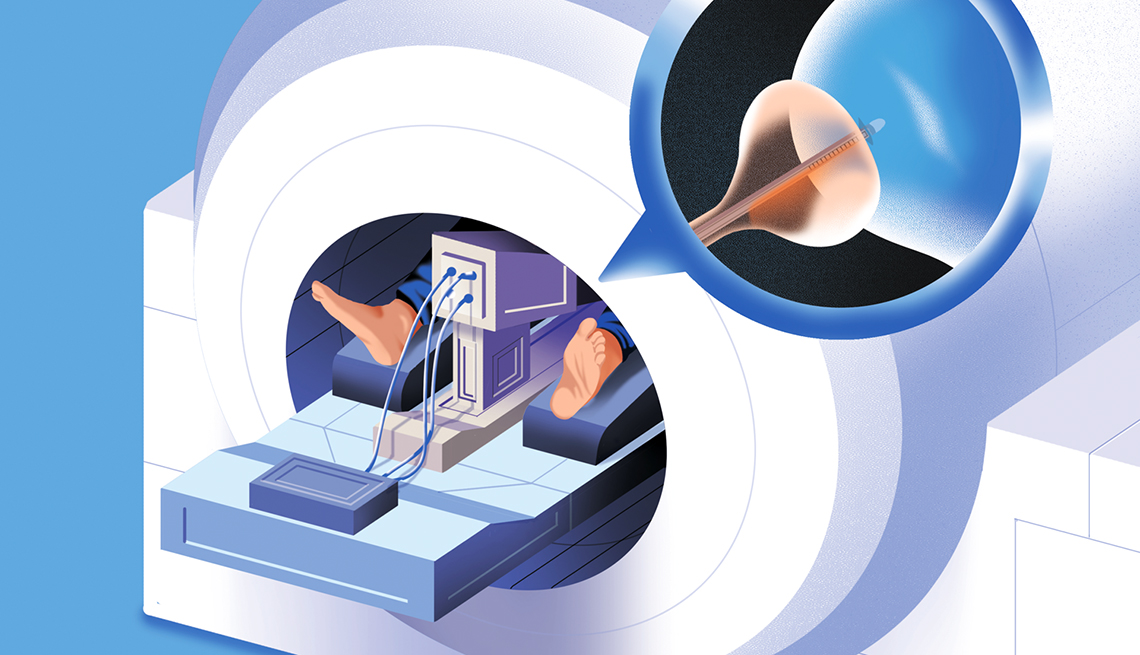 TULSA-PRO: The Latest Procedure for Prostate Cancer Treatment