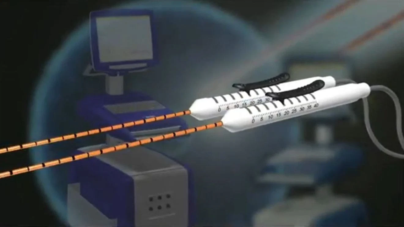 NanoKnife Pancreatic Cancer Treatment: A Comprehensive Guide