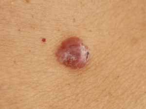 Basal Cell Skin Cancer ICD-10: Accurate Coding, Diagnosis, and Clinical ...