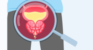 Biochemical Relapse in Prostate Cancer: Understanding PSA Recurrence ...