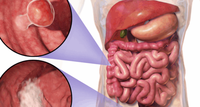 Transverse Colon Cancer: Symptoms, Treatment, and Outlook