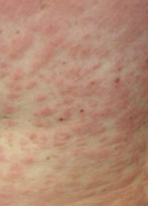 What You Need to Know About Liver Cancer Rash