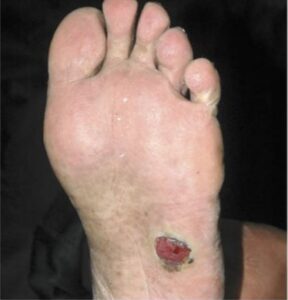 Lump on Toe