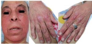 What Does a Lung Cancer Skin Rash Look Like?