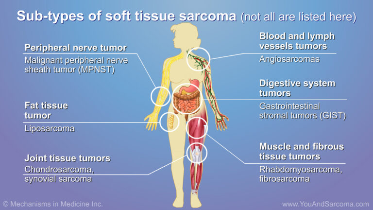 Subcutaneous Lumps in Soft Tissue Sarcoma