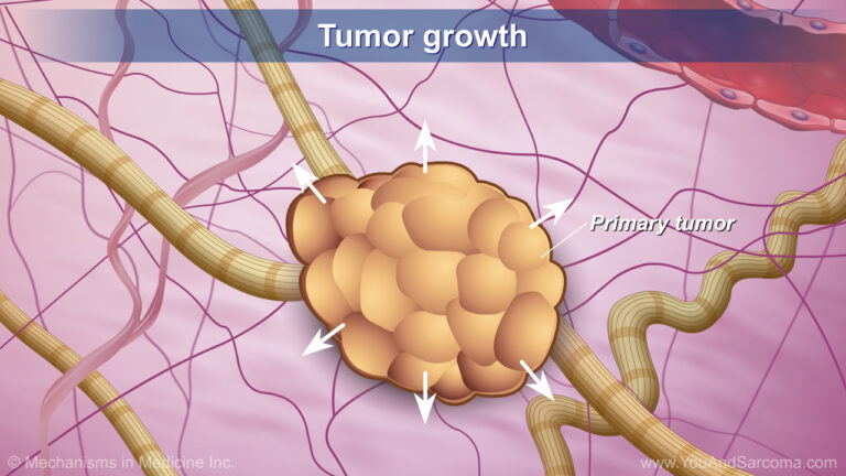 Subcutaneous Lumps in Soft Tissue Sarcoma