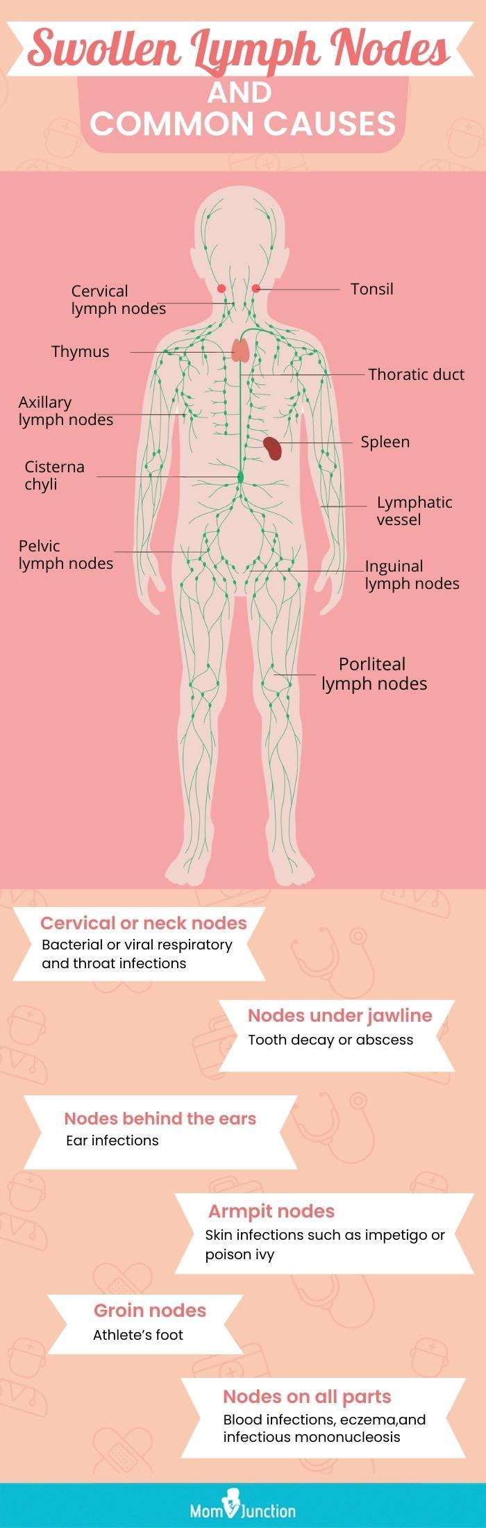 Swollen Lymph Nodes in Leukemia